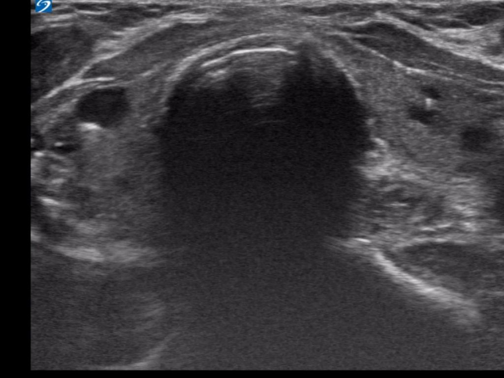 Oesophageal intubation : Double tract sign - Critical Care Sonography