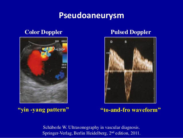 Question 5: Groin lump post angioplasty - Critical Care Sonography