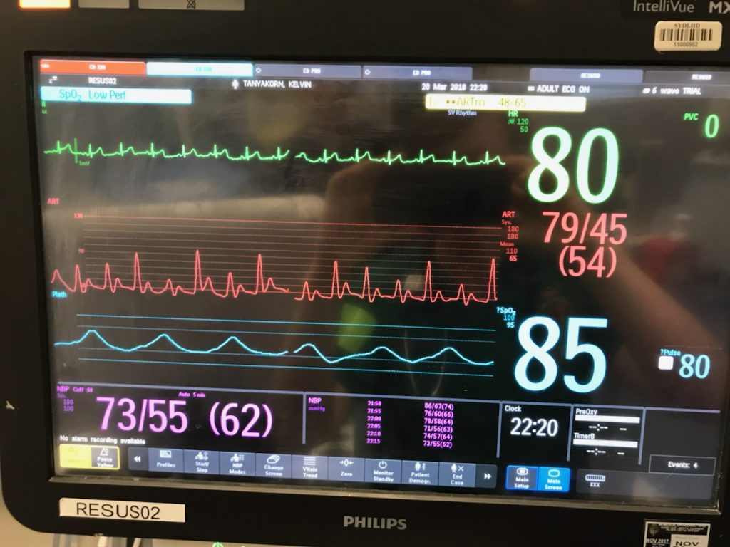Pericardial Tamponade - Critical Care Sonography