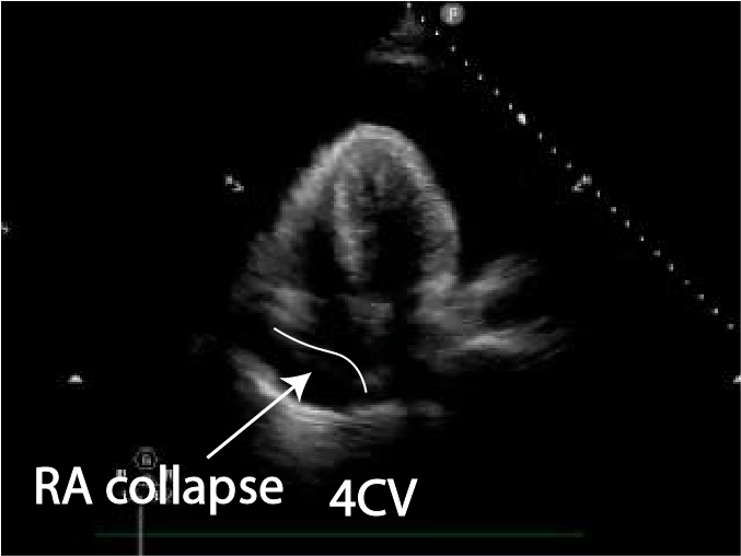 Pericardial Tamponade - Critical Care Sonography