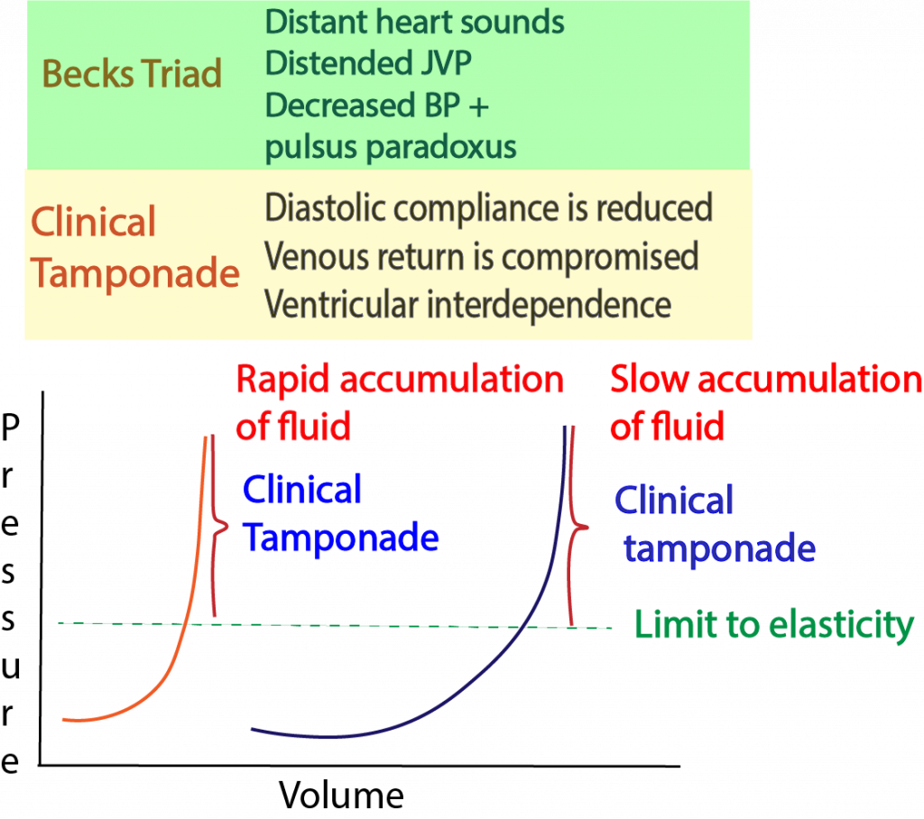 Pericardial Tamponade - Critical Care Sonography