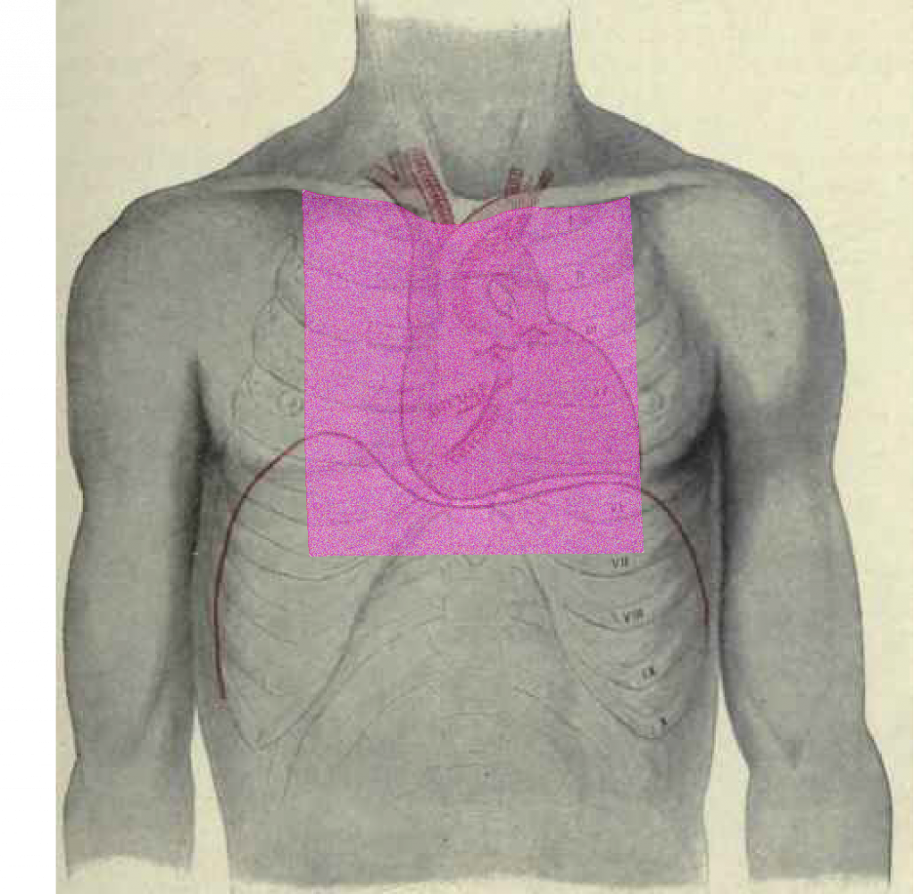 Trauma : knife through chest - Critical Care Sonography