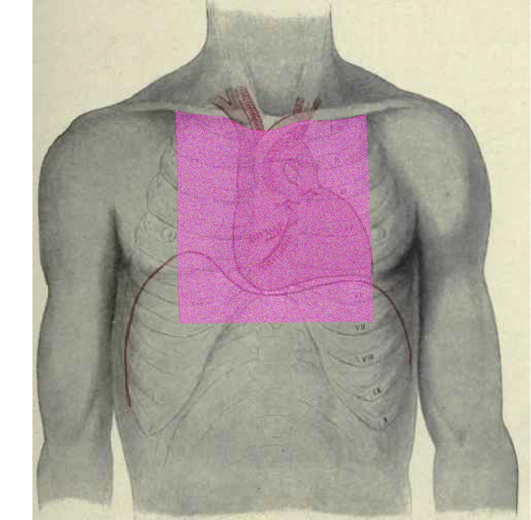 Trauma : knife through chest - Critical Care Sonography