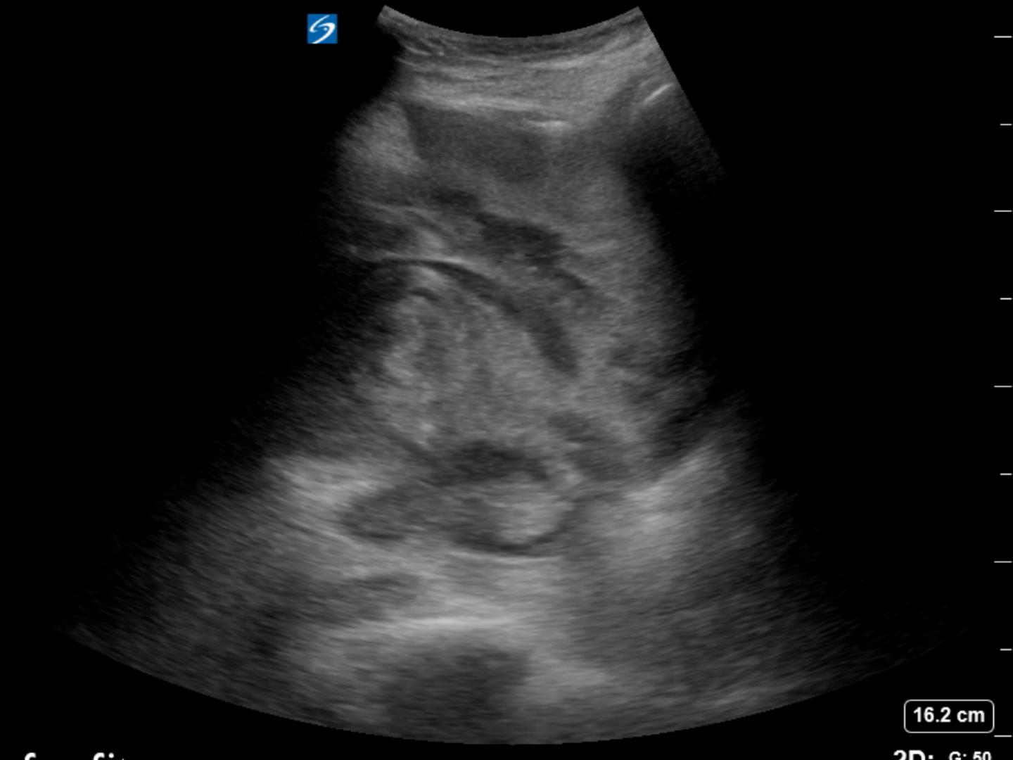 Pitfall: Ruptured cornual ectopic pregnancy - Critical Care Sonography