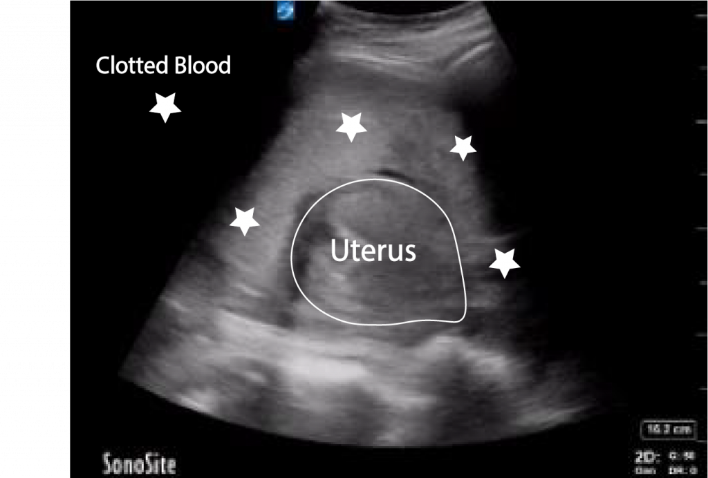 Pitfall: Ruptured cornual ectopic pregnancy - Critical Care Sonography
