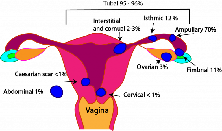 Pitfall: Ruptured cornual ectopic pregnancy - Critical Care Sonography