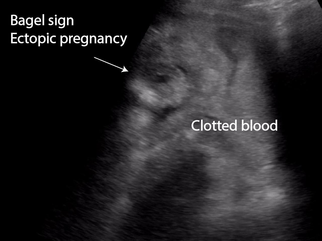 Pitfall: Ruptured cornual ectopic pregnancy - Critical Care Sonography