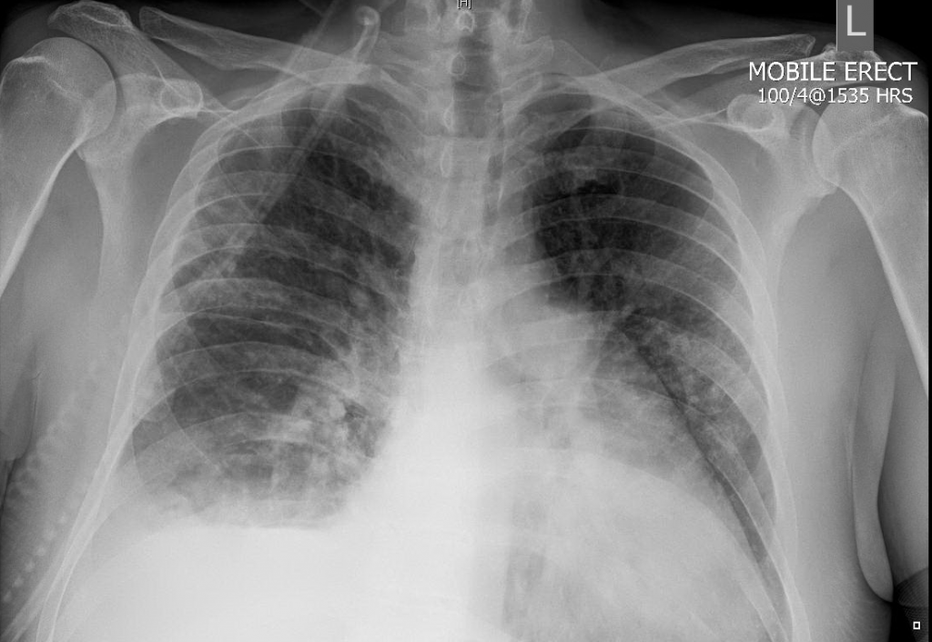 Bacterial endocarditis : Tricuspid valve - Critical Care Sonography