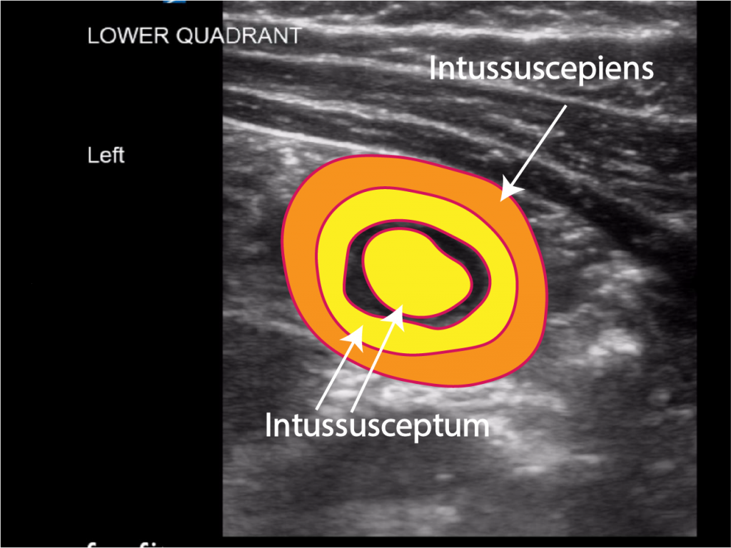 Intussusception in a 6 year old - Critical Care Sonography