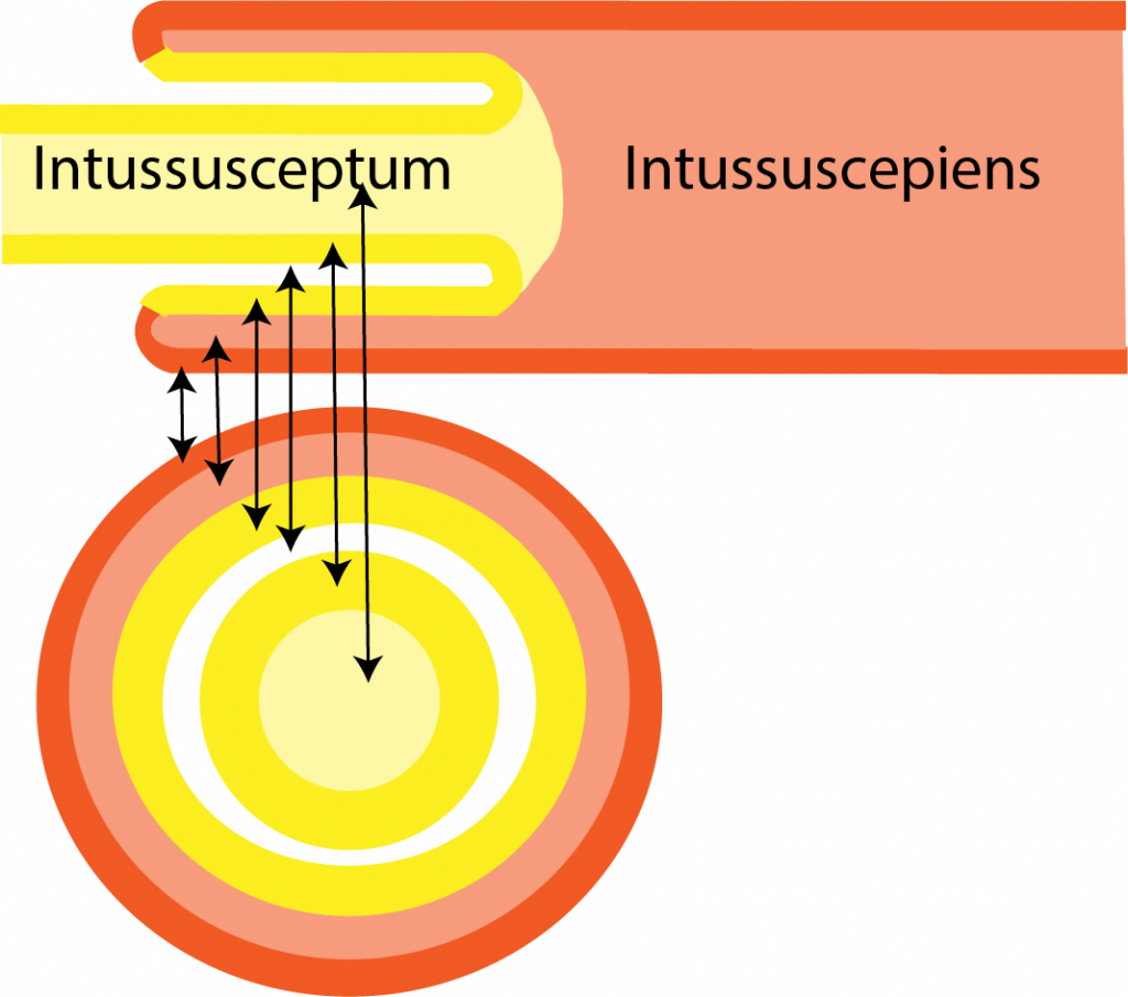 Intussusception in a 6 year old - Critical Care Sonography