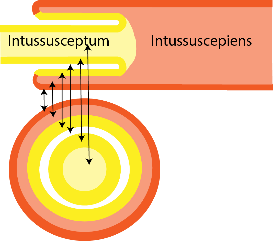 Intussusception in a 6 year old - Critical Care Sonography