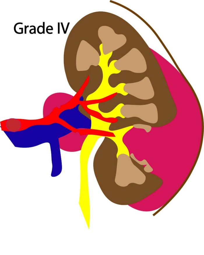 Trauma: Right kidney laceration - Critical Care Sonography