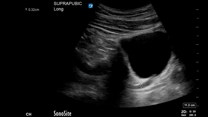 Renal stones in PUJ - Critical Care Sonography
