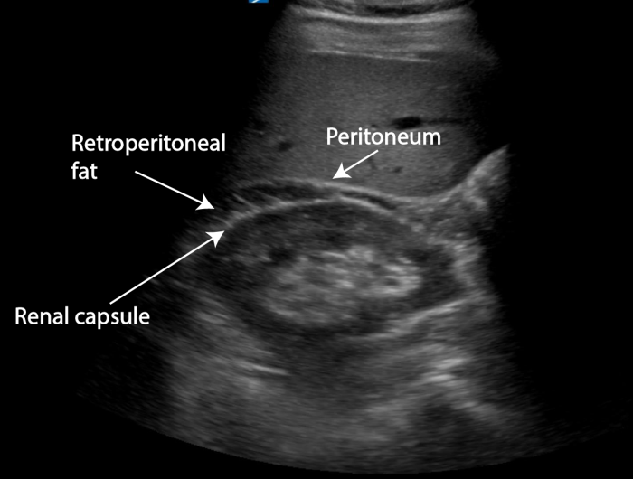 Trauma: Right kidney laceration - Critical Care Sonography