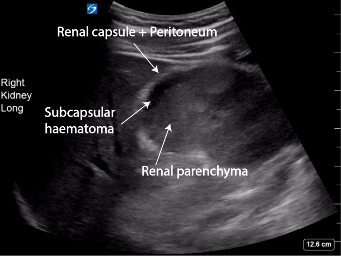 Trauma: Right kidney laceration - Critical Care Sonography