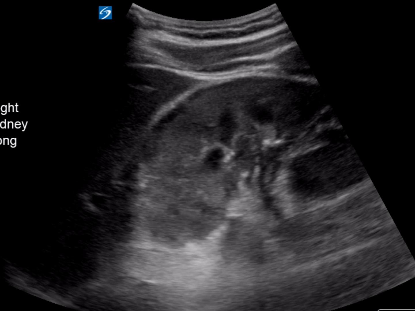 Trauma: Right kidney laceration - Critical Care Sonography