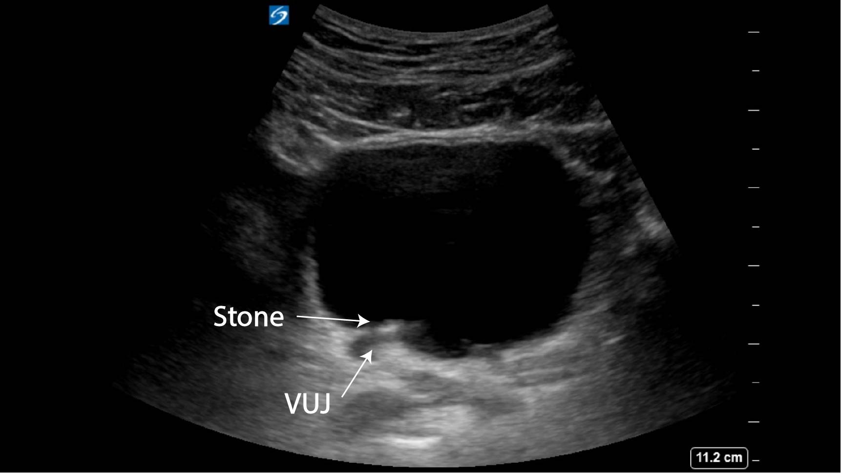 Renal stones in PUJ - Critical Care Sonography