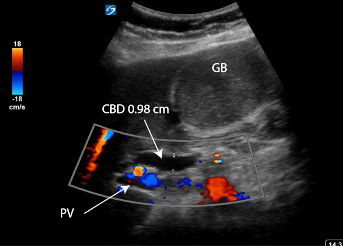 Cholecystitis and obstruction of the CBD - Critical Care Sonography