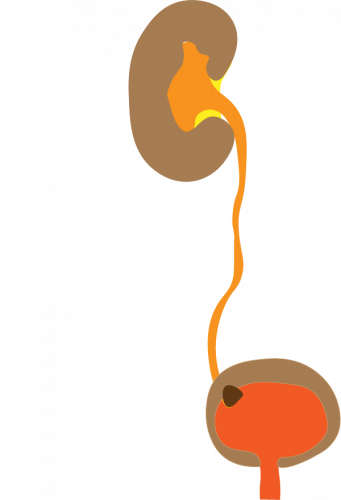 Renal stones in PUJ - Critical Care Sonography