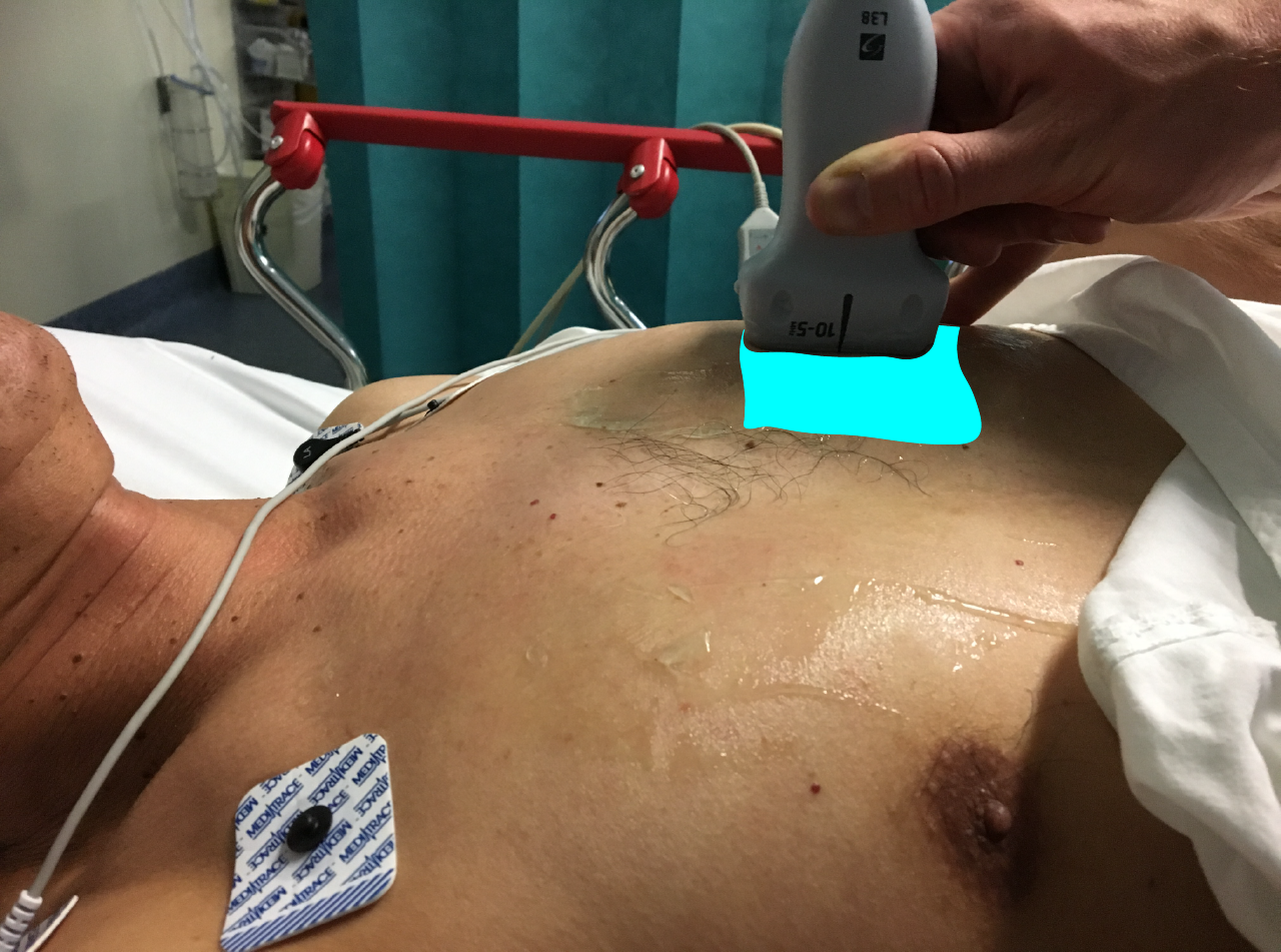 Pneumothorax : Where do we place the probe? - Critical Care Sonography