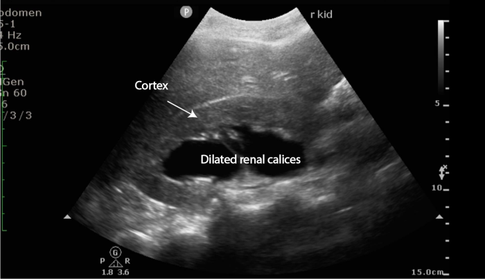 Acute vs Chronic Hydronephrosis - Critical Care Sonography