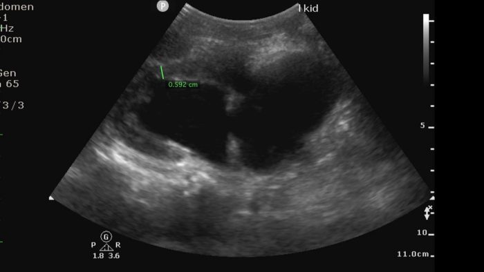 Acute vs Chronic Hydronephrosis - Critical Care Sonography