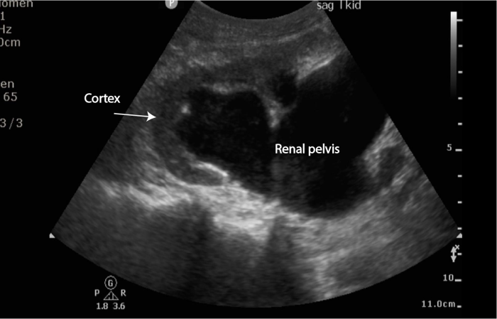 Acute vs Chronic Hydronephrosis - Critical Care Sonography
