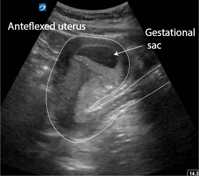 Pitfall : Retroverted uterus - Critical Care Sonography