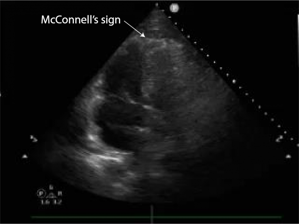 Lung ultrasound for pulmonary embolism - Critical Care Sonography