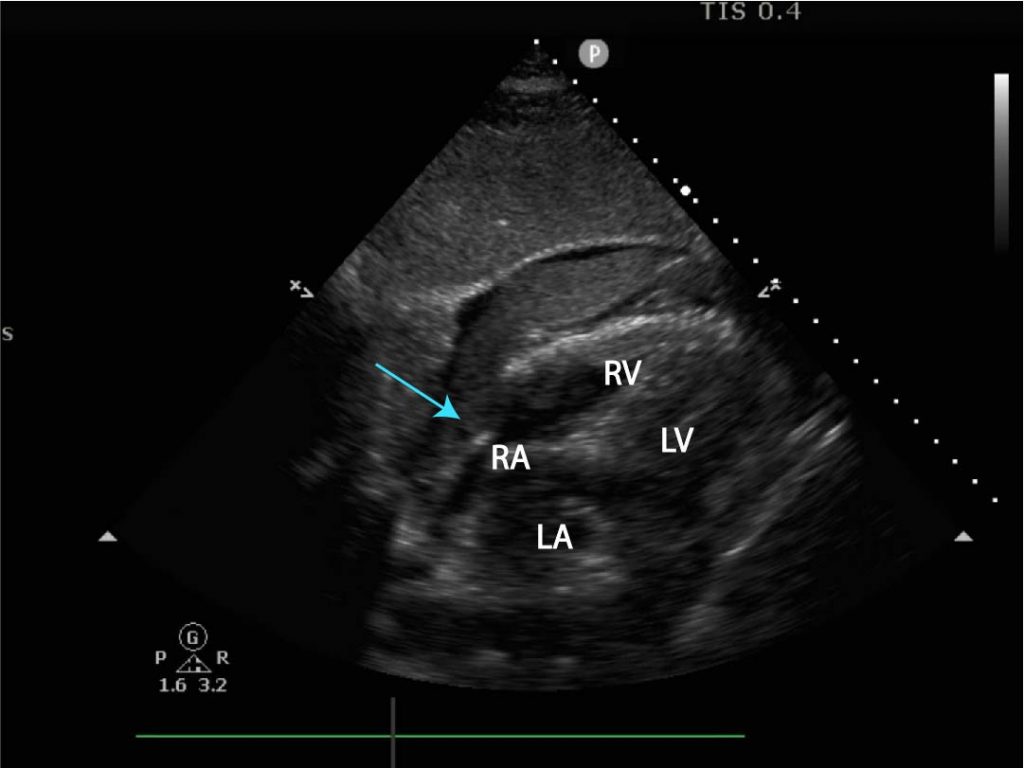 Dissection - Critical Care Sonography