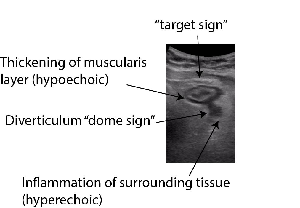 Diverticulitis - Critical Care Sonography