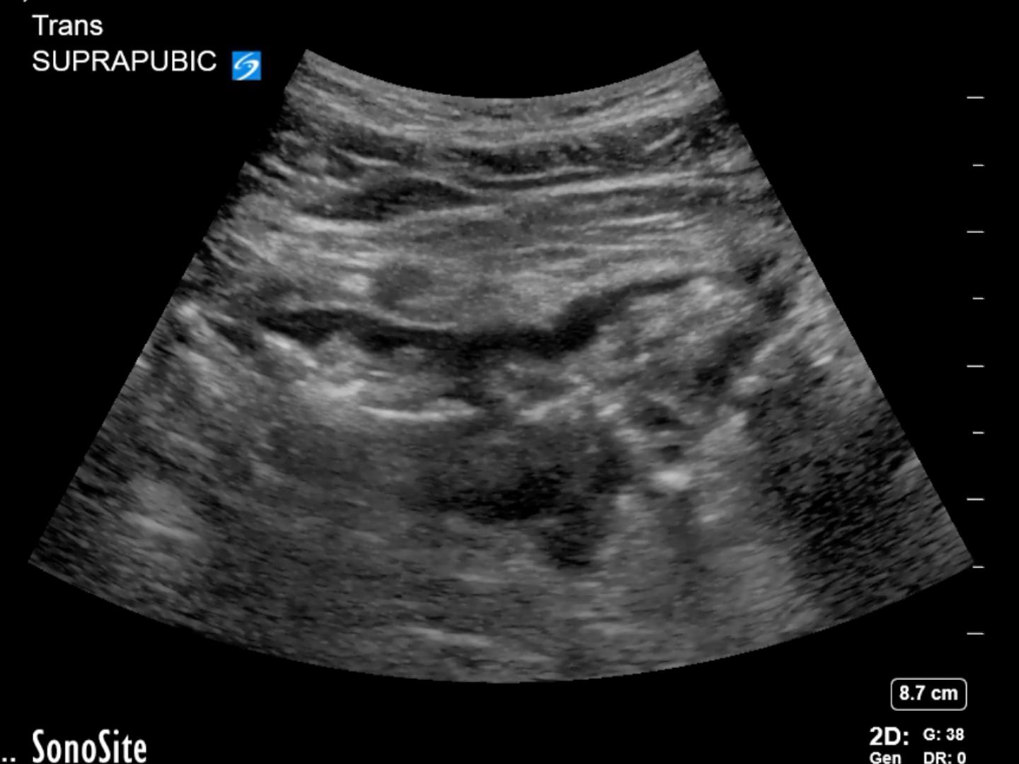 Diverticulitis - Critical Care Sonography