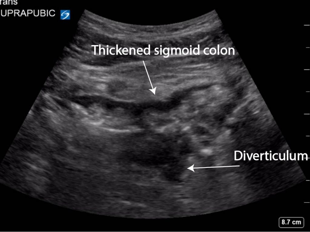 Diverticulitis - Critical Care Sonography