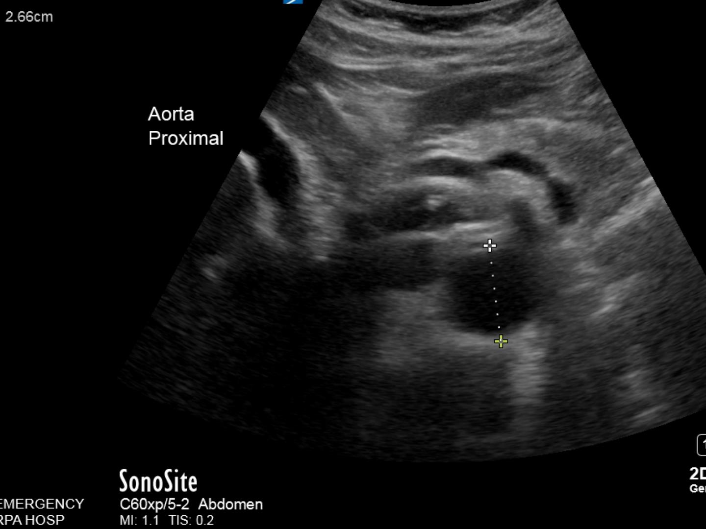 Stanford type B dissection - Critical Care Sonography