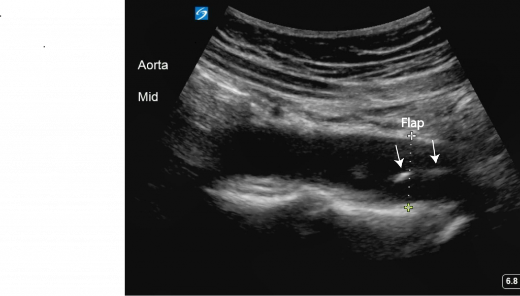 10. Case of the month: Stanford type B dissection - Critical Care ...