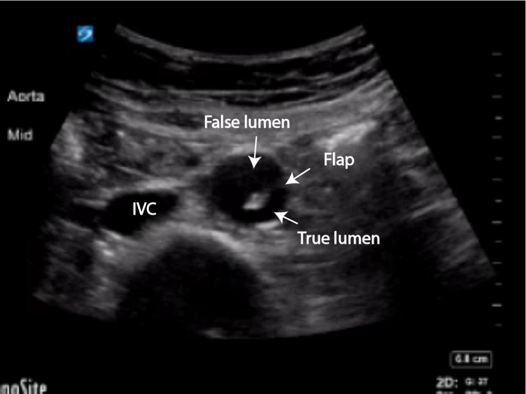 10. Case of the month: Stanford type B dissection - Critical Care ...