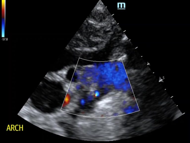 Coarctation of the aorta in a neonate - Critical Care Sonography