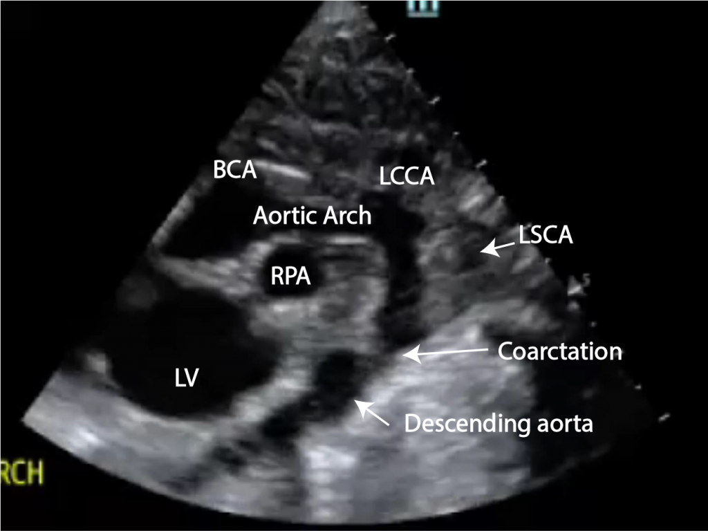 Coarctation of the aorta in a neonate - Critical Care Sonography