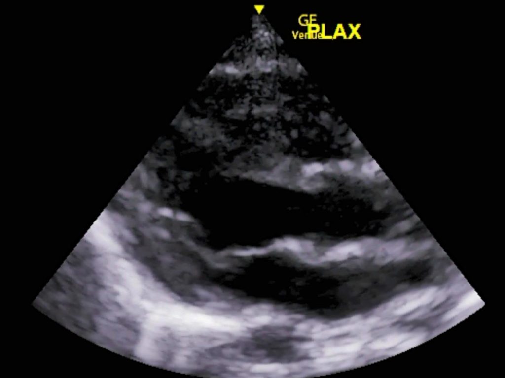 VSD in a 3 month old - Critical Care Sonography