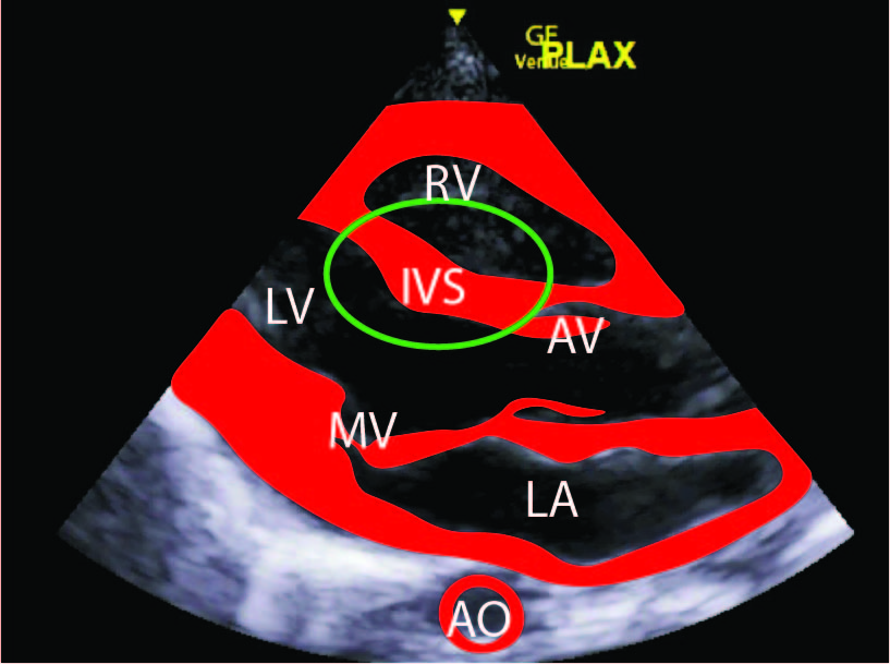 VSD in a 3 month old - Critical Care Sonography