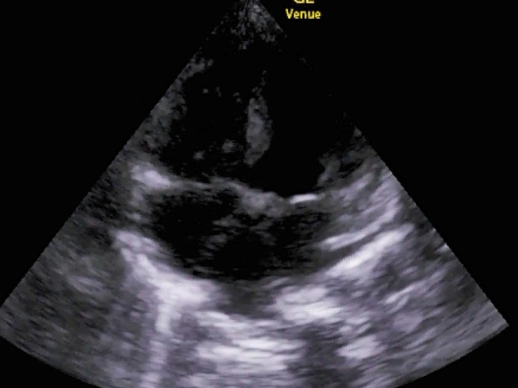 VSD in a 3 month old - Critical Care Sonography
