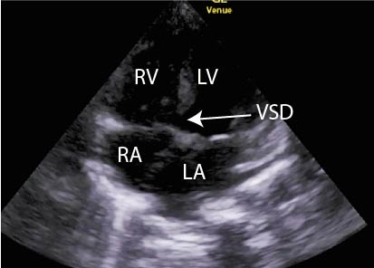 VSD in a 3 month old - Critical Care Sonography