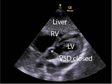 VSD in a 3 month old - Critical Care Sonography