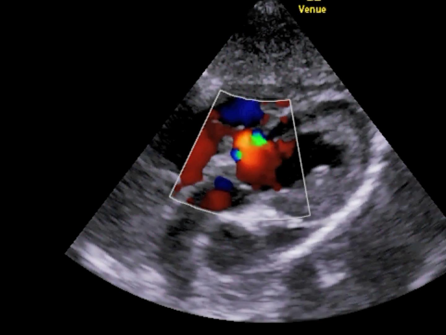 VSD in a 3 month old - Critical Care Sonography