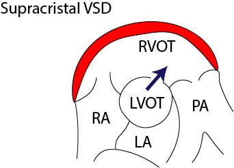 VSD in a 3 month old - Critical Care Sonography