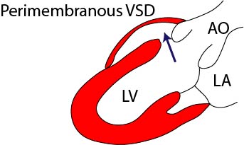 VSD in a 3 month old - Critical Care Sonography