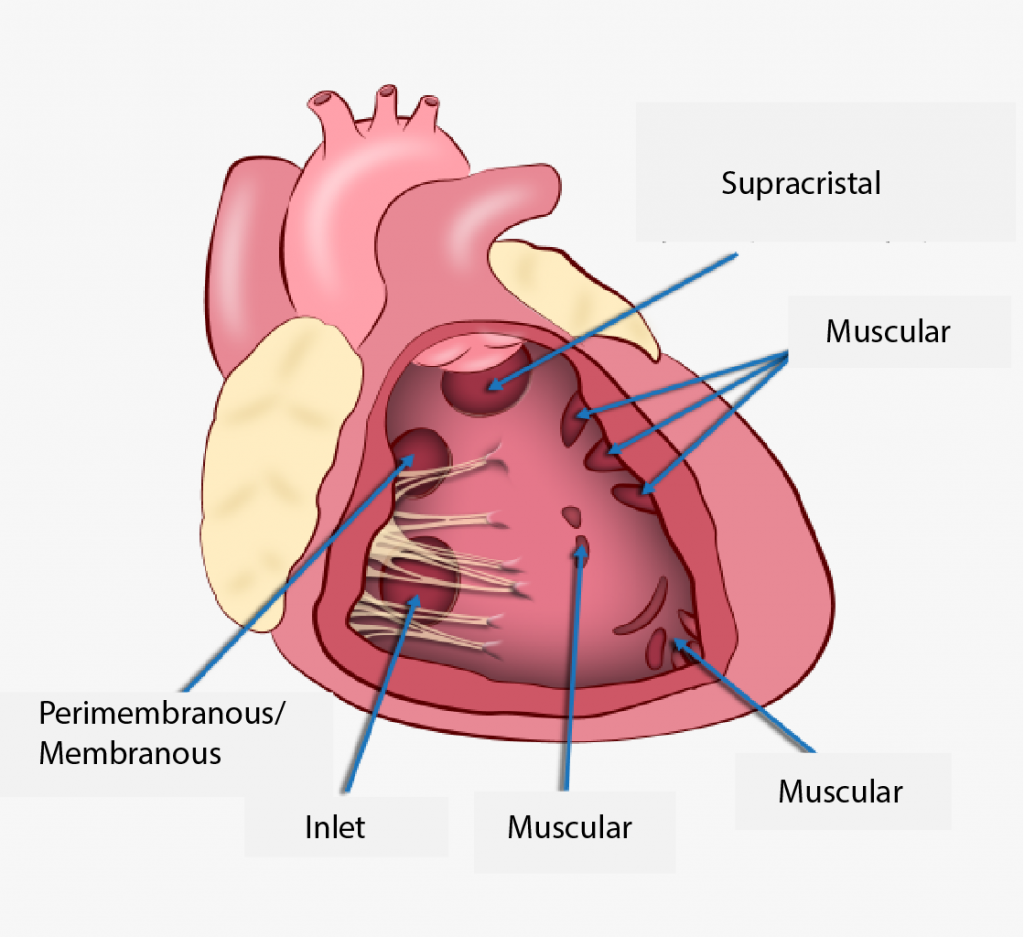 VSD in a 3 month old - Critical Care Sonography