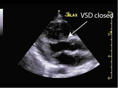 VSD in a 3 month old - Critical Care Sonography