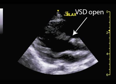 VSD in a 3 month old - Critical Care Sonography