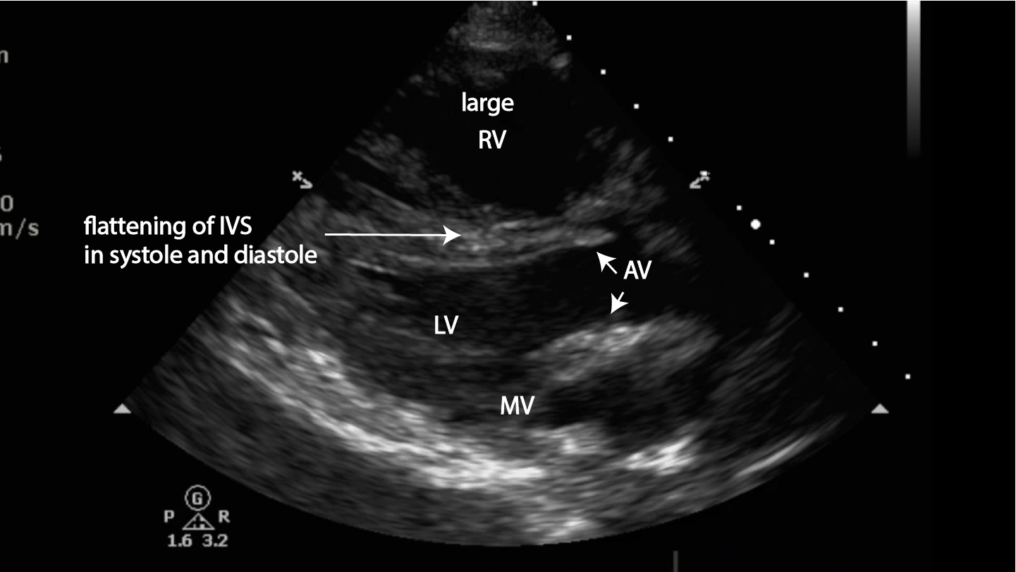 Pulmonary hypertension in a child - Critical Care Sonography